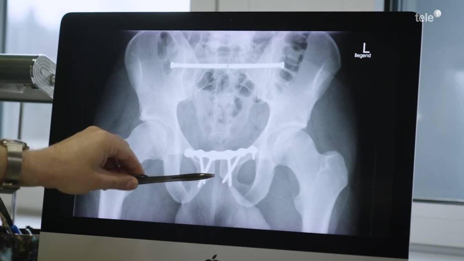 Beckenbruch bei Spitzensportler | Tele1