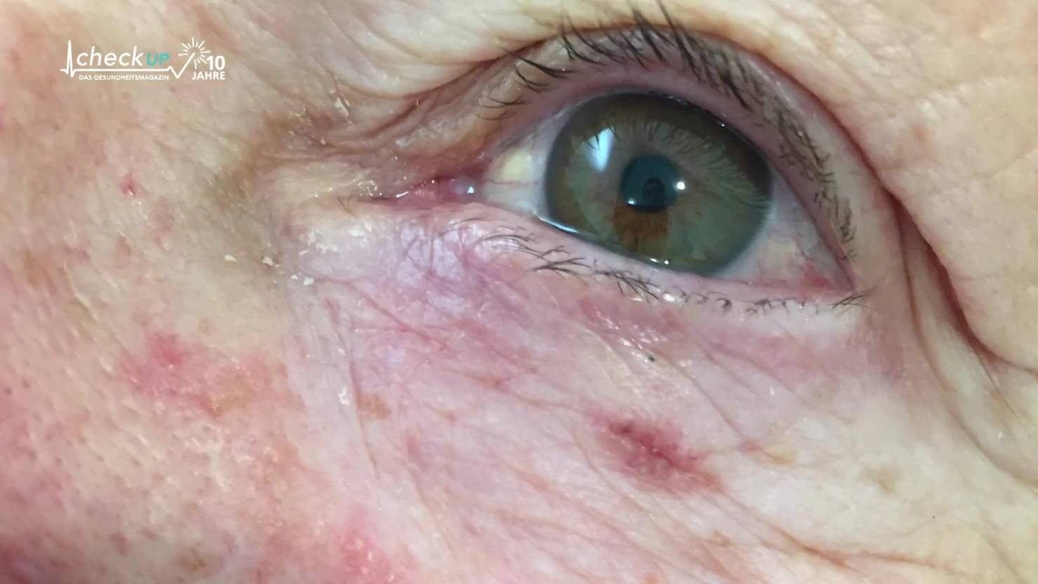 Behandlung von weissem Hautkrebs im Gesicht | TeleBaern