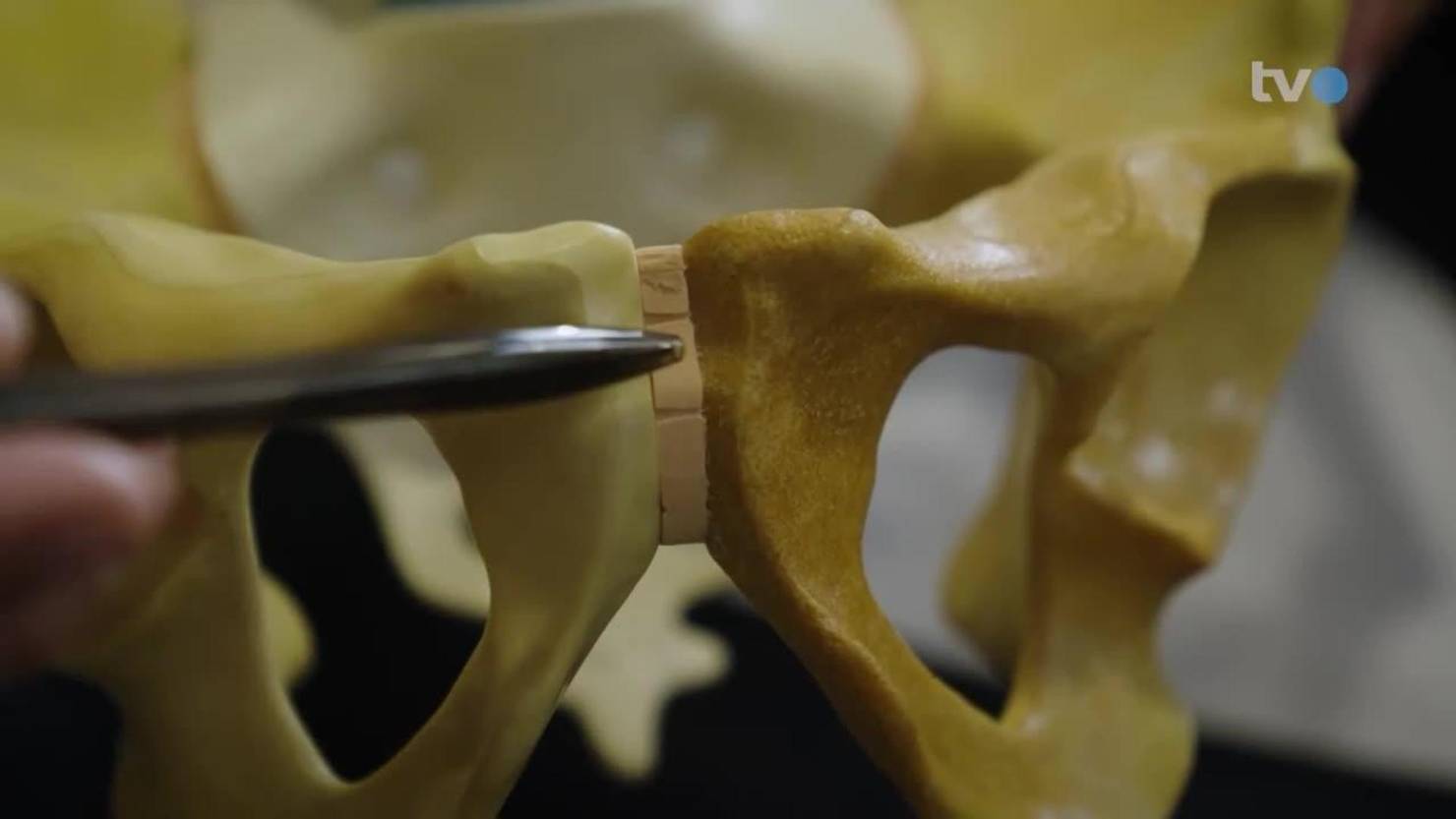 Beckenbruch bei Spitzensportler | TVO Online