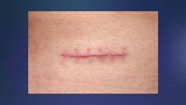 Narbenbehandlung mit Microneedling | TeleZüri